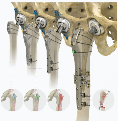 Femur compression plate - Zimed Medical