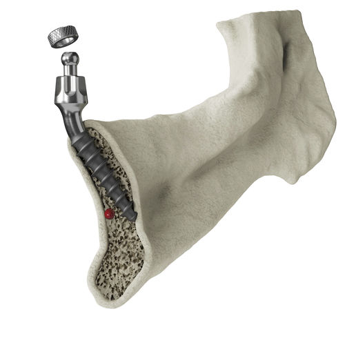 Conical dental implant - Maxifix Compressive P - NSI srl - titanium ...