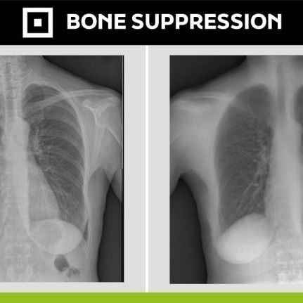 Diagnostic software - Bone Suppression - Digitec - post-processing / medical / radiography