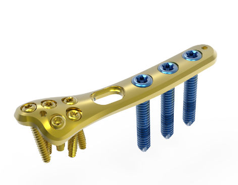 Ulna compression plate - TRUE LOCK - Truemed Medical - distal / locking ...