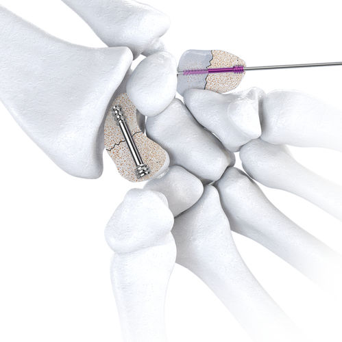 Carpal joint compression bone screw - AGOMED Medizin-Technik ...