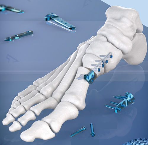 Hallux valgus osteotomy plate - A-TEC - AGOMED Medizin-Technik ...