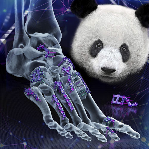 Foot phalange compression plate - PANDA - AGOMED Medizin-Technik ...