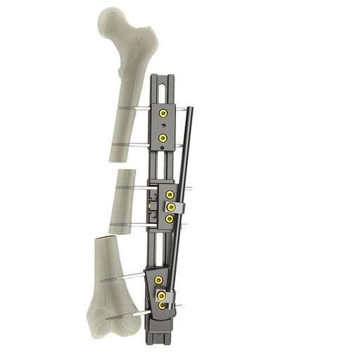 Femur external fixation system - UniX® - WishBone Medical - tubular / adult