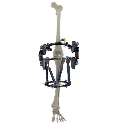 Knee external fixation system - WishBone Medical - circular / adult