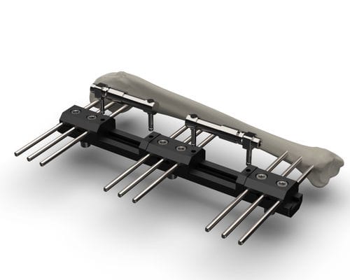 Humerus external fixation system - TF-ERS - TASARIMMED - tubular / adult