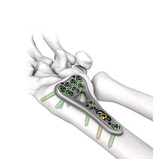 Radius compression plate - Changzhou Dingjian Medical Equipment ...