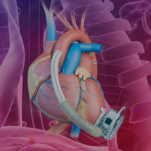 Adult ventricular assist device - CH-VAD® - Suzhou Tongxin Medical ...