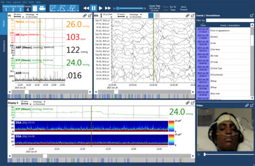 Research biosignal acquisition system - MOBERG® CNS - Natus Micromed ...