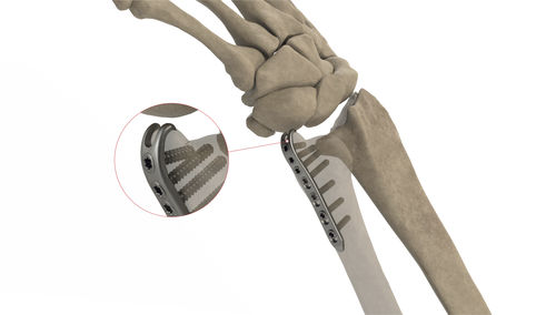 Ulna compression plate - Styloid LP - Ases Orthopedics - locking