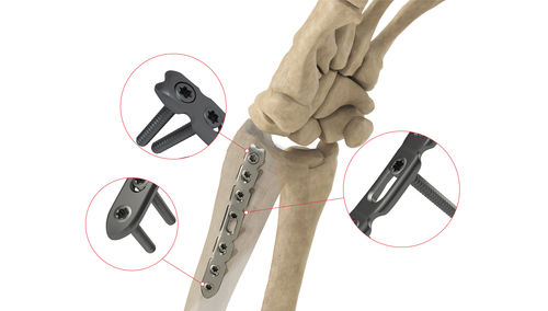 Radius compression plate - DR Lateral LP - Ases Orthopedics - distal ...