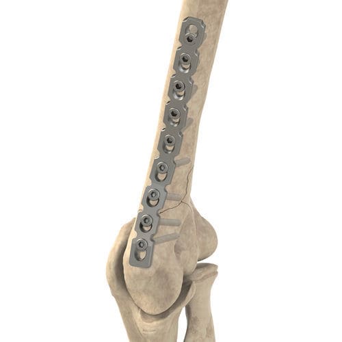 Pelvic compression plate - Ases Orthopedics - locking