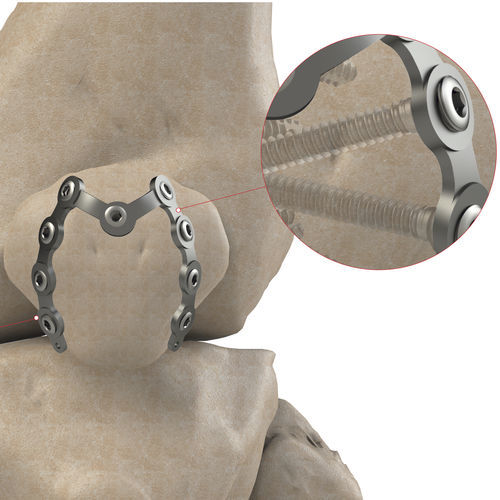 Patella compression plate - Ases Orthopedics - locking