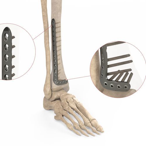 Tibia compression plate - Ases Orthopedics - distal / anterolateral / locking