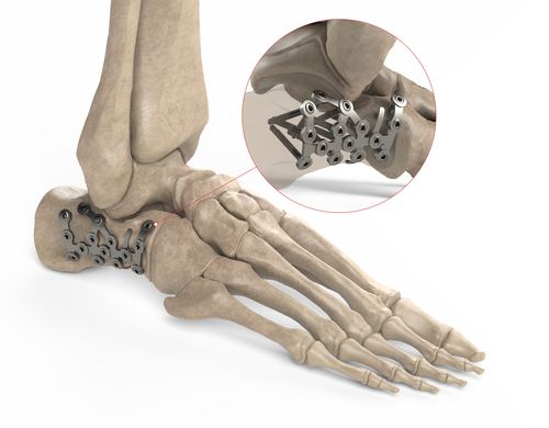 Calcaneus compression plate - Ases Orthopedics