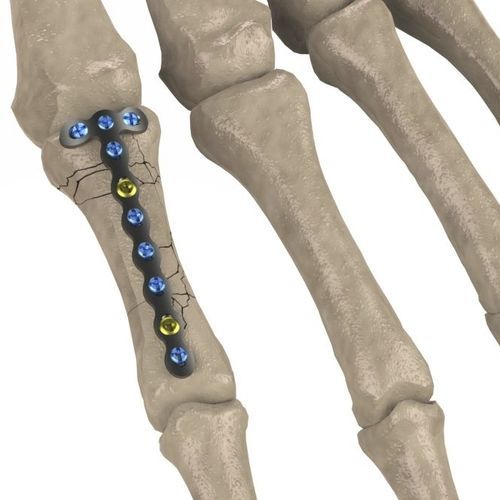 Metacarpophalangeal joint compression plate - 1T112-100122033 - Ases ...