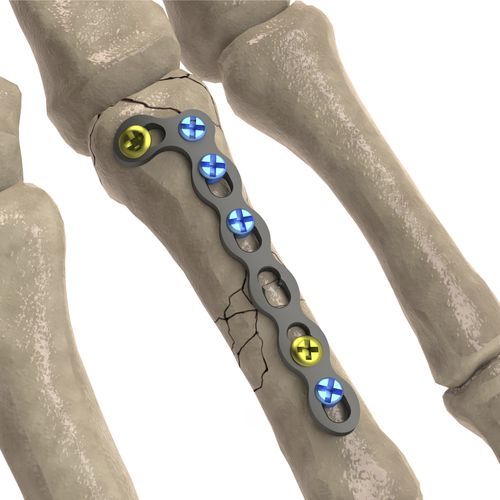 Hand phalange compression plate - LCP Oblique L - Ases Orthopedics ...