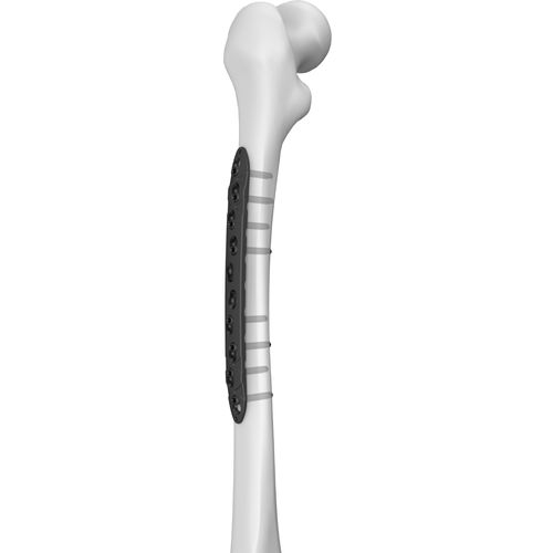Femur compression plate - 301027 series - Boneunion Medical - mid-shaft ...