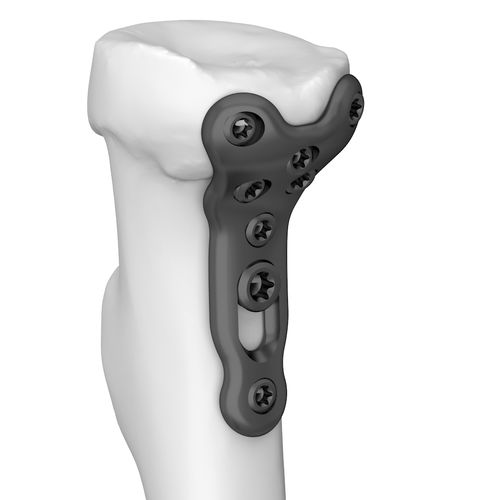 Radius compression plate - 301178 series - Boneunion Medical - radial ...