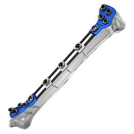 Tibia external fixation system - Aplus Biotechnology - tubular / pediatric