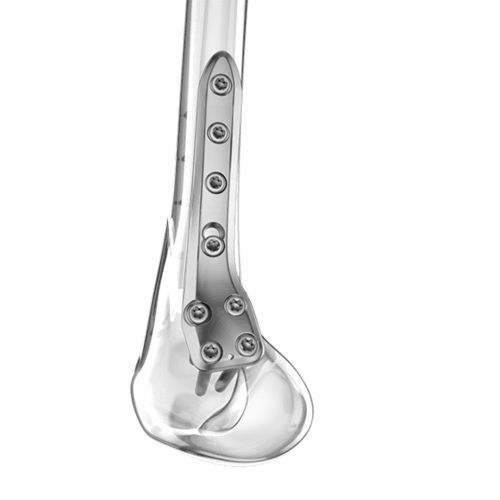 Femoral osteotomy plate - Aplus Biotechnology - distal / locking / titanium