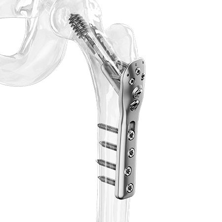 Trochanter compression plate - 2500-0020:0021 series - Aplus ...