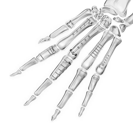 Hand phalange compression plate - 1600 series - Aplus Biotechnology ...