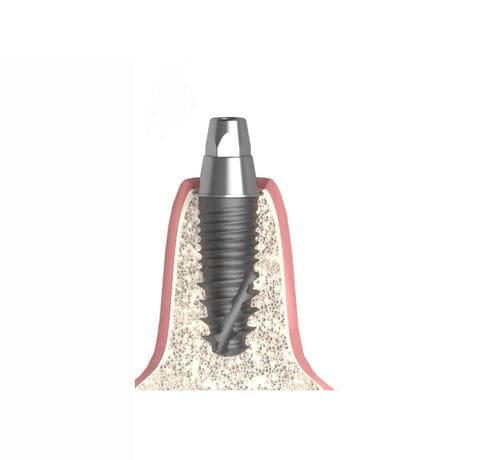 Conical implant abutment - Actival - Bionika Medline Kft. - external ...