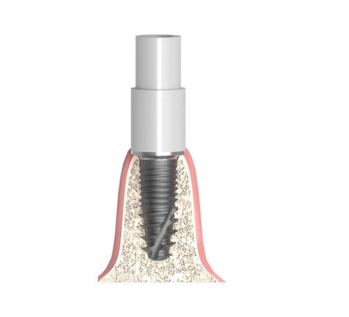 Cylindro-conical implant abutment - Actival - Bionika Medline Kft ...