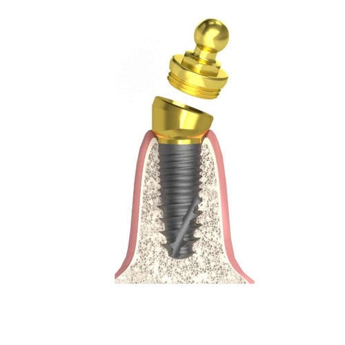 Cylindro-conical implant abutment - Actival - Bionika Medline Kft ...