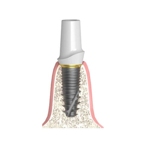 Conical implant abutment - Bioplant - Bionika Medline Kft. - zirconia / internal / straight