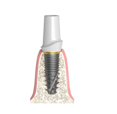 Cylindro-conical implant abutment - UNIFORM SIC® ace® max® - Bionika ...