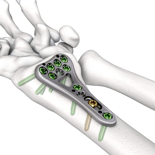 Radius compression plate - LOQTEQ® VA 2.5 - aap Implantate - distal ...