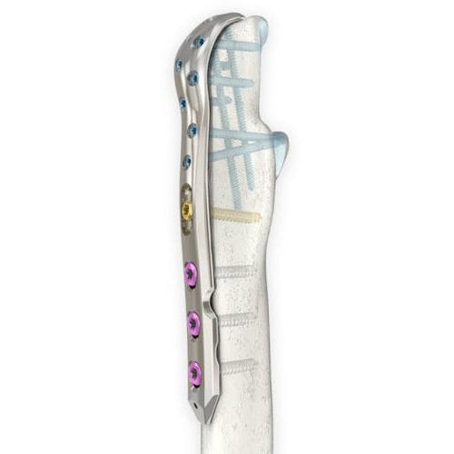 Ulna compression plate - LOQTEQ® 2.7/3.5 - aap Implantate - proximal ...