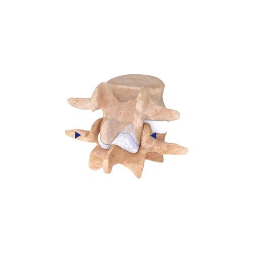 Lumbar interspinous vertebral implant - IntraSPINE® - Cousin Biotech