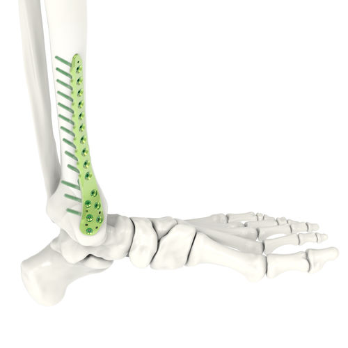 Tibia compression plate - ARIX 3.5/4.0 - Jeil Medical Corporation ...