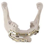 Mandible compression plate - Facial iD - Stryker - locking / metallic