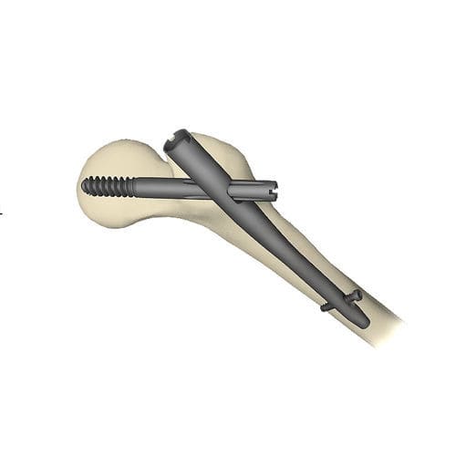 Femoral intramedullary nail - Gamma3 - Stryker - trochanter / proximal ...