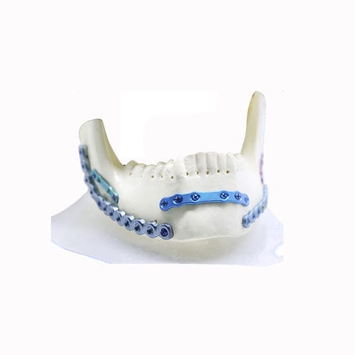 Mandible compression plate - Double Medical Technology - locking