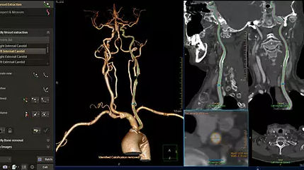 Analysis software - IntelliSpace Portal 12 - Philips Healthcare ...