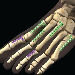 Metatarsophalangeal joint compression plate - VLP™ MINI-MOD™ - Smith ...