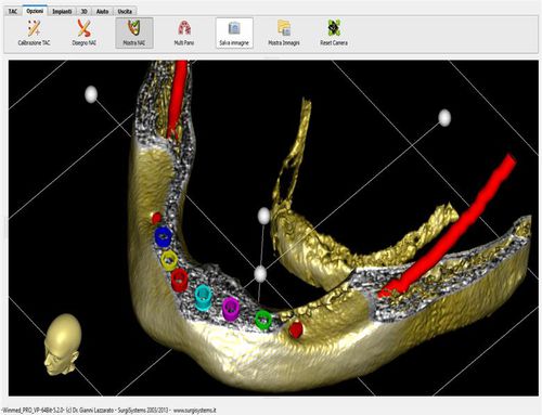 3D viewing software - Winmed - ARTIGLIO SNC - planning / surgical / for ...