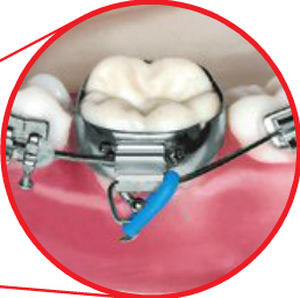 Orthodontic archwire - Molar Correction Spring - FORESTADENT BERNHARD ...