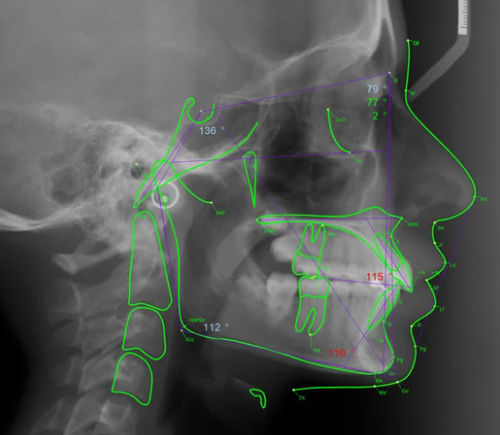 Cephalometric analysis software - Romexis® - Planmeca - planning ...
