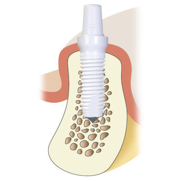 Cylindrical dental implant - Z5m - Z-Systems AG - ceramic / one-piece ...