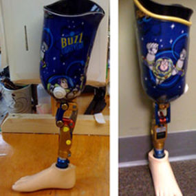 Transtibial prosthetic socket - Boston Orthotics + Prosthetics