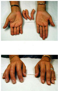Finger cosmetic prosthesis - Boston Orthotics + Prosthetics - partial ...