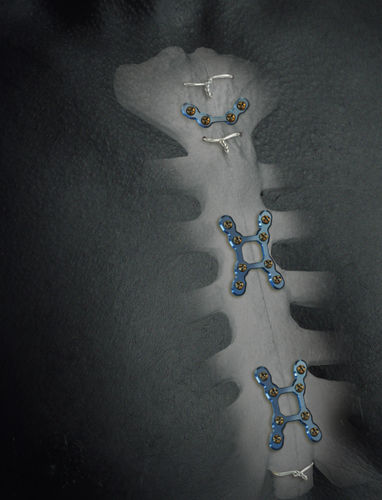 Sternum compression plate - SternaLock® - Zimmer Biomet - locking ...