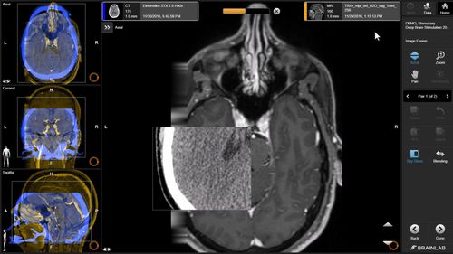 Control software - Brainlab - visualization / planning / interpretation