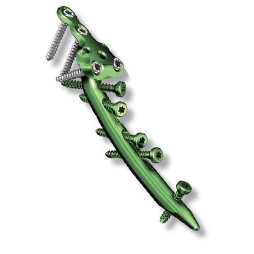 Radius intramedullary nail - Charfix2 - ChM - distal fixation / titanium